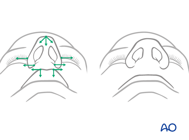 Maxillary vestibular approach