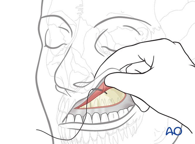 Maxillary vestibular approach