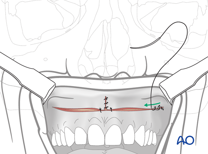 Maxillary vestibular approach