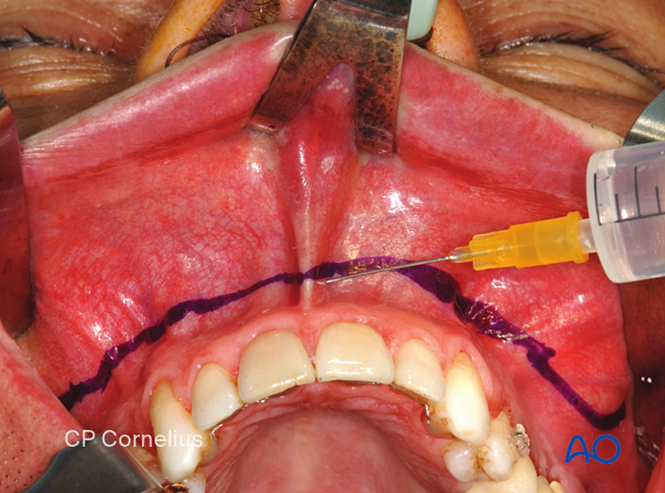 Maxillary vestibular approach