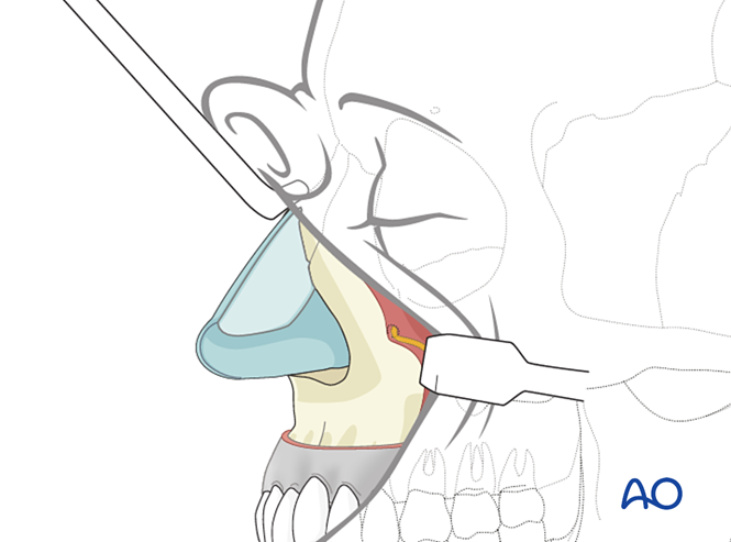Midfacial degloving approach