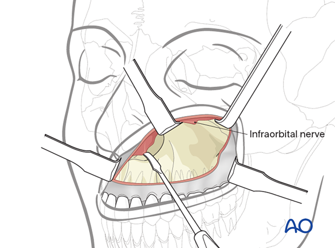 Midfacial degloving approach