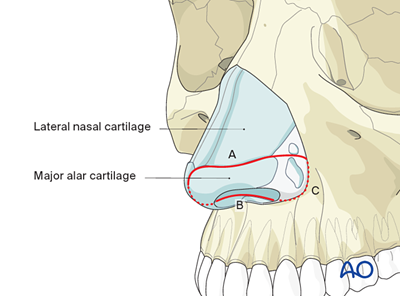 Midfacial degloving approach