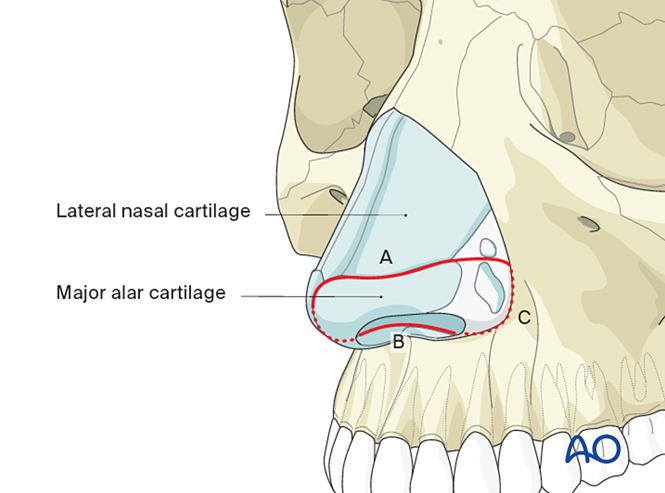 Midfacial degloving approach