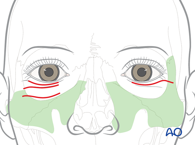 Transcutaneous lower eyelid approaches