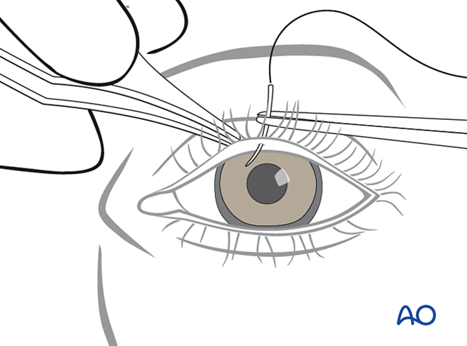 Upper eyelid approach