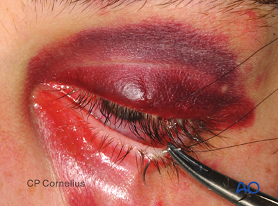 Transcutaneous lower eyelid approaches