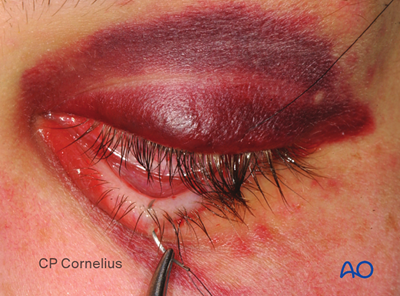 Transcutaneous lower eyelid approaches