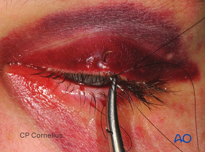 Transcutaneous lower eyelid approaches