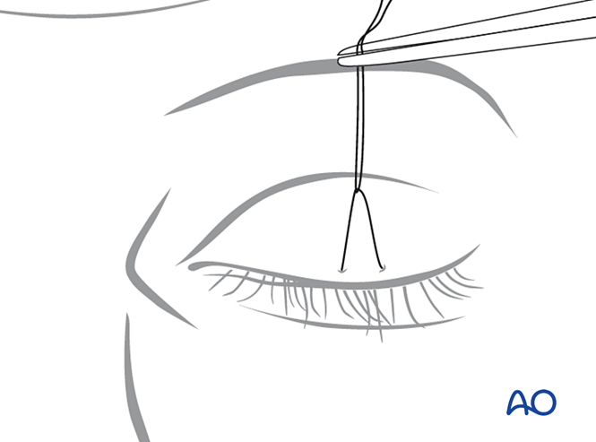 Transcutaneous lower eyelid approaches