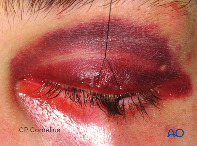 Transcutaneous lower eyelid approaches