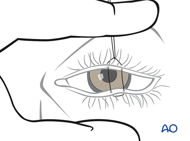 Transcutaneous lower eyelid approaches