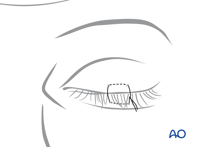 Transcutaneous lower eyelid approaches