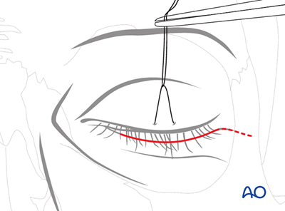 Subciliary approach