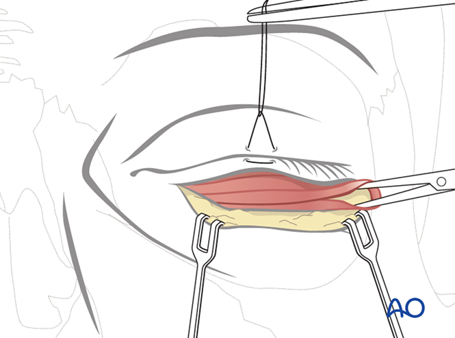 Subciliary approach