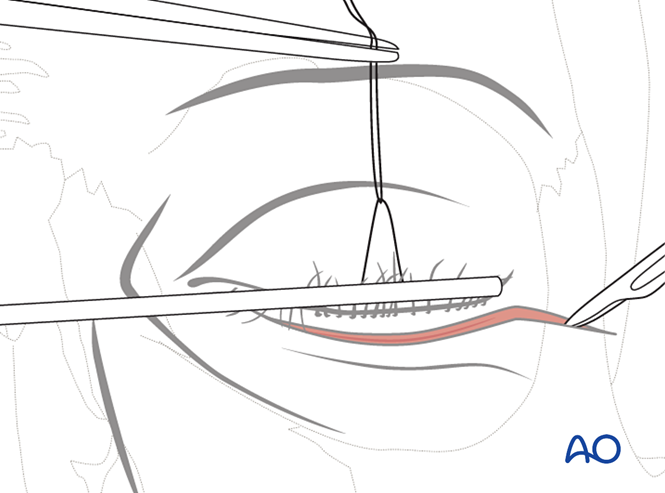 Subciliary approach