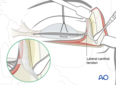 Subciliary approach