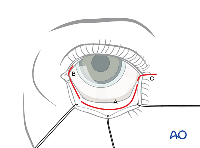 Transconjunctival approaches