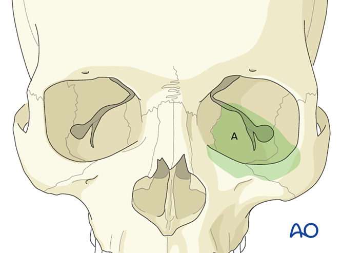 Transconjunctival approaches