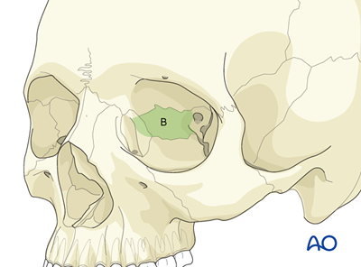 Transconjunctival approaches
