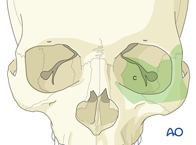 Transconjunctival approaches