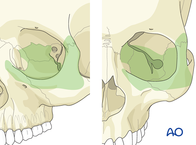 Transconjunctival approaches