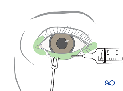 Transconjunctival approaches