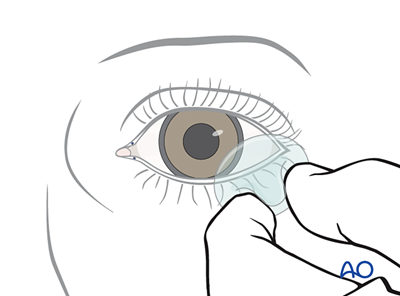 Transconjunctival approaches