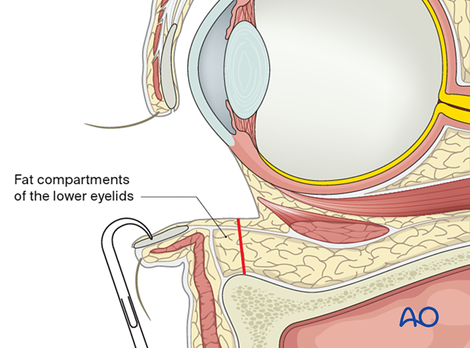 Inferior fornix transconjunctival