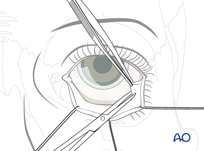 Inferior fornix transconjunctival