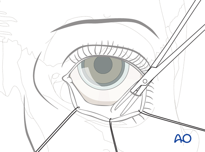 Inferior fornix transconjunctival