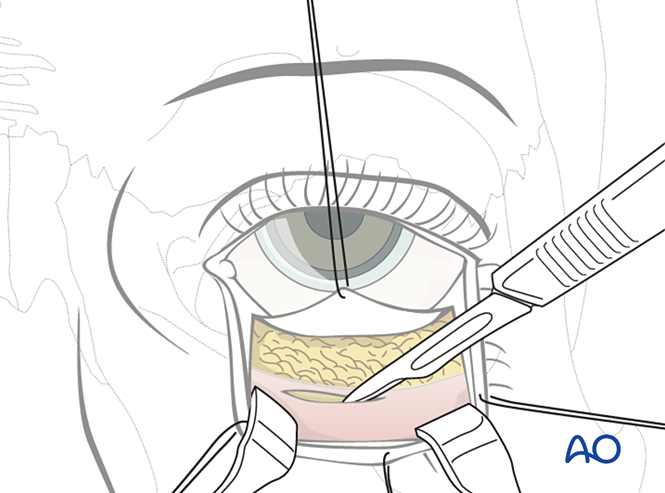 Inferior fornix transconjunctival
