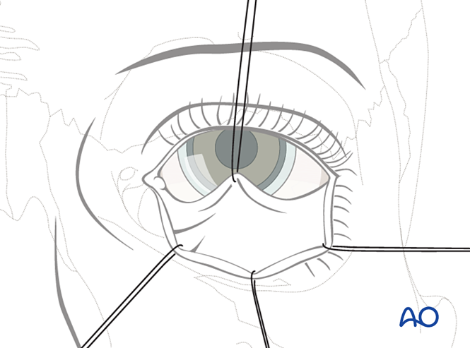 Inferior fornix transconjunctival