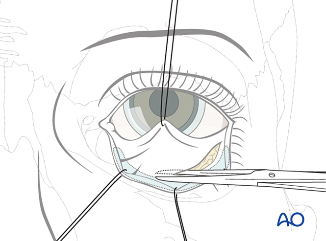 Inferior fornix transconjunctival