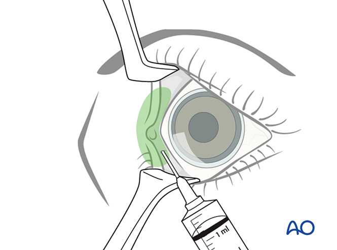 Pre-/Transcaruncular approach