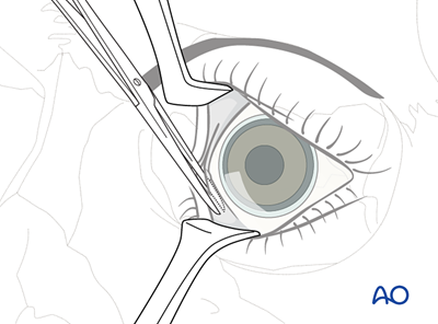 Pre-/Transcaruncular approach