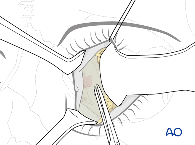 Pre-/Transcaruncular approach