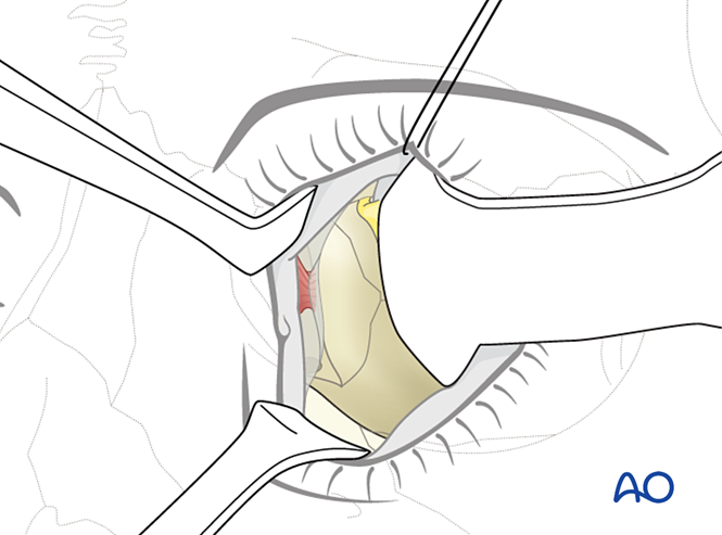 Pre-/Transcaruncular approach