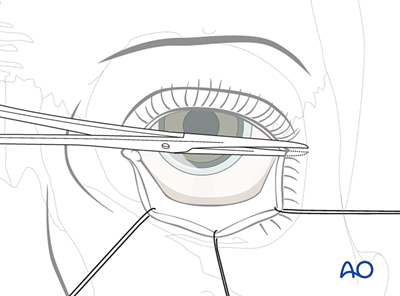 Transconjunctival approach with lateral skin extension