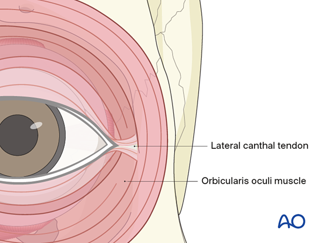 Transconjunctival approach with lateral skin extension