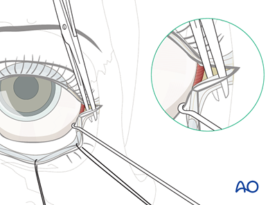 Transconjunctival approach with lateral skin extension