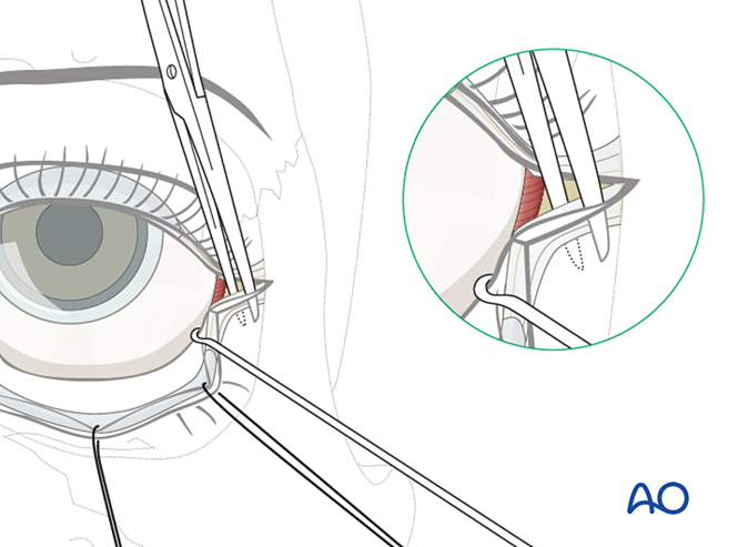 Transconjunctival approach with lateral skin extension