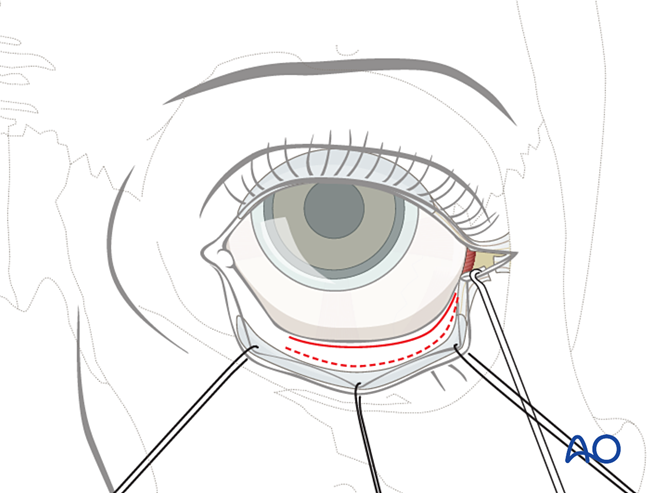 Transconjunctival approach with lateral skin extension