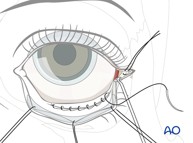 Transconjunctival approach with lateral skin extension