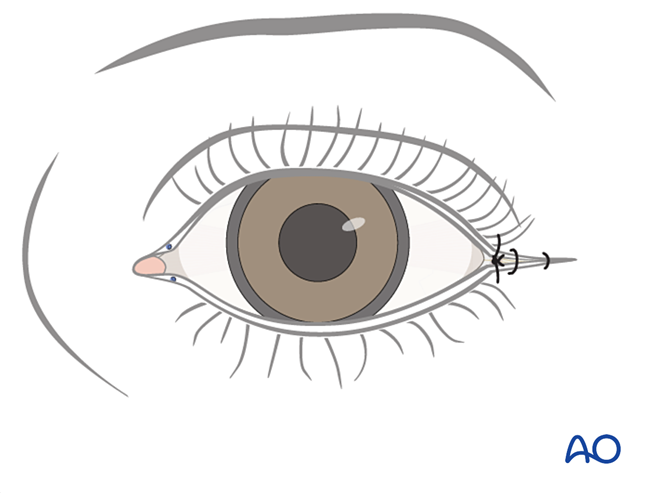 Transconjunctival approach with lateral skin extension