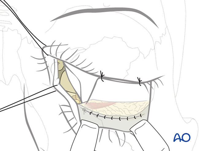 Combination of inferior and medial transconjunctival
