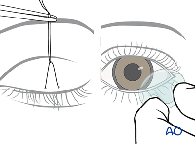 Upper eyelid approach