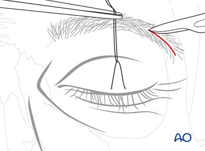 Lateral eyebrow approach