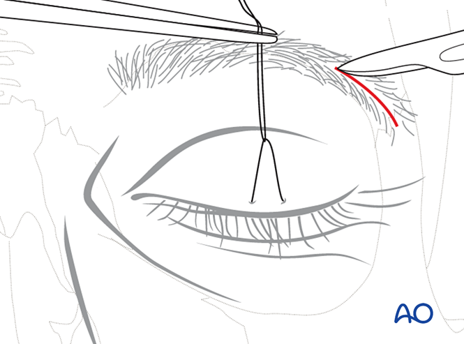 Lateral eyebrow approach