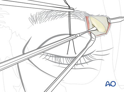 Lateral eyebrow approach